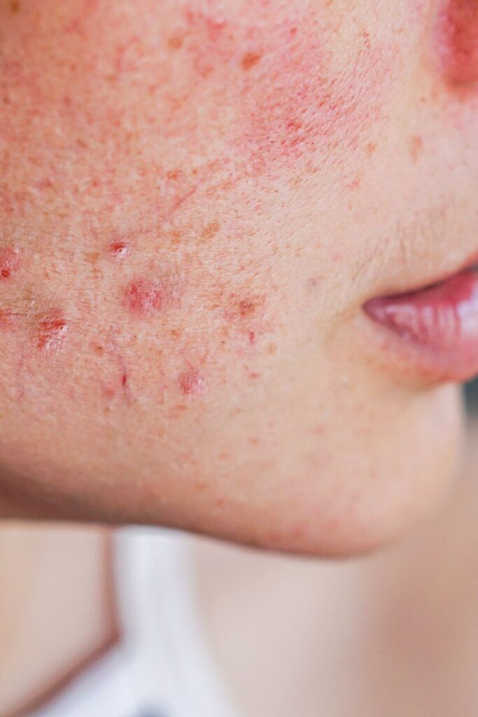 7 Best Herbs For Hormonal Acne Natural Remedies